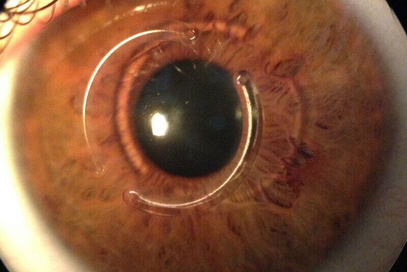 keratoconus uk