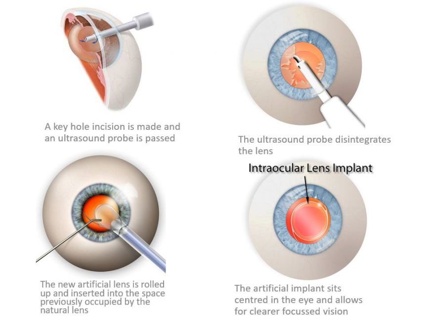 eye implants uk