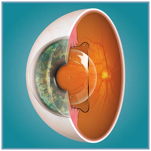 eye implants uk