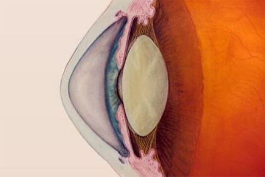 keratoconus uk